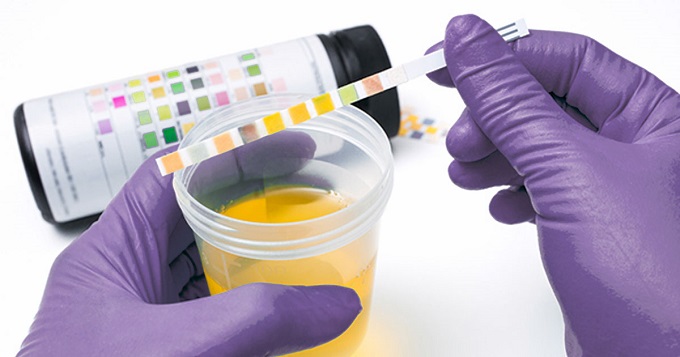 Boja urina – kakva je normalna a kakva je ako imate neki problem