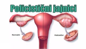 Policistični jajnici, Sindrom policističnih jajnika – simptomi, uzrok i lečenje