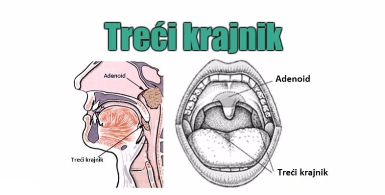 Treći krajnik kod dece i odraslih – simptomi, operacija, oporavak i ...