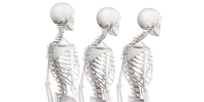 Kifoza kičme – simptomi, uzrok, vežbe i lečenje