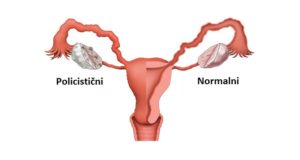 Policistični jajnici, Sindrom policističnih jajnika – simptomi, uzrok i lečenje