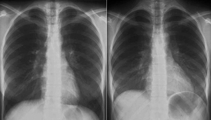 Pneumotoraks pluća – prva pomoć, uzrok, simptomi, posledice, oporavak i ...