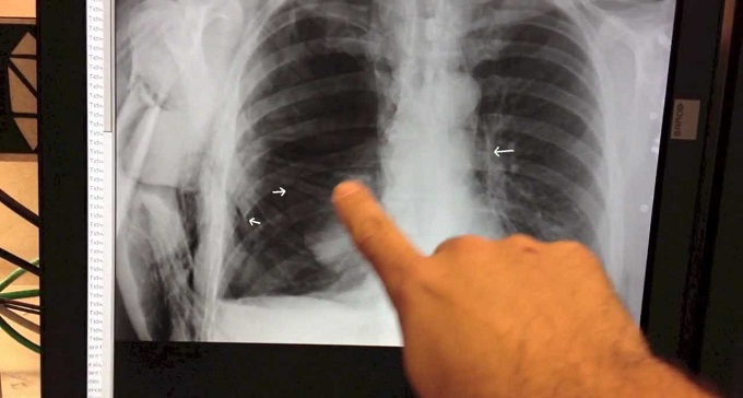 Pneumotoraks pluća – prva pomoć, uzrok, simptomi, posledice, oporavak i ...