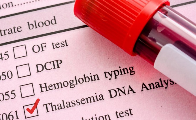 Talasemija – simptomi, uzrok i lečenje