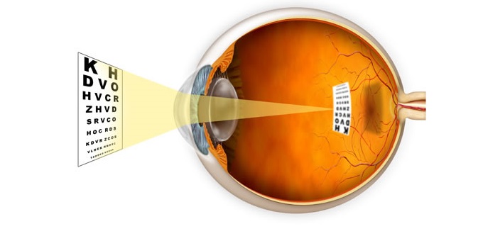 Kratkovidnost – simptomi, uzrok, dioptrija i lečenje