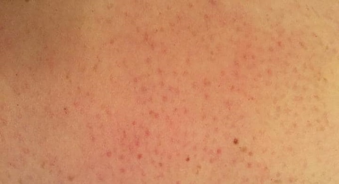 Crvene tačkice po telu – zašto se pojavljuju, lečenje